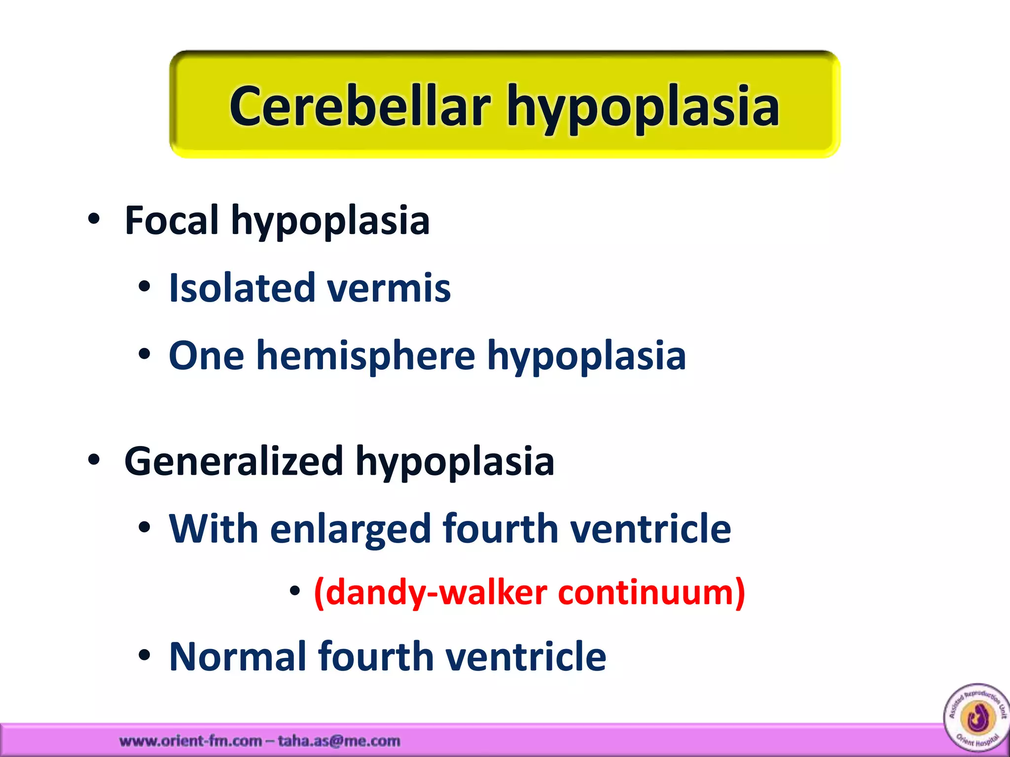 Malformations of Cerebellum | PPTX