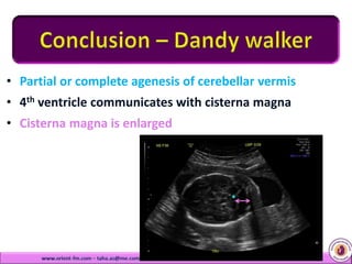 Cerebellar Vermis In Mass
