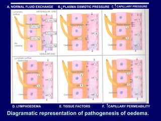 11-oedema.ppt