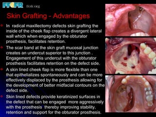 11. palatal resections alterations at surgery to enhance the prosthetic ...