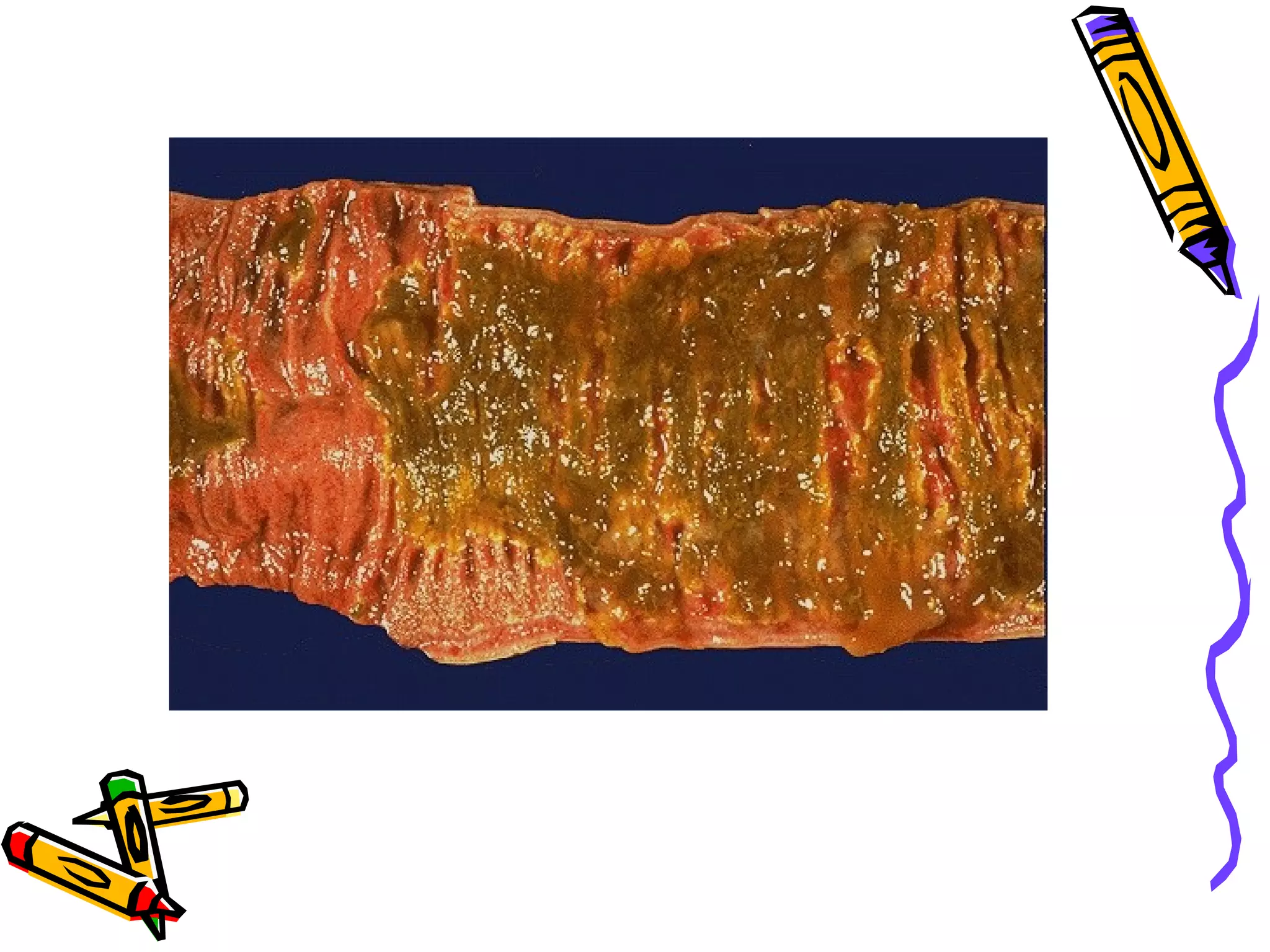 11. Pseudomembranous Colitis Images | PPT