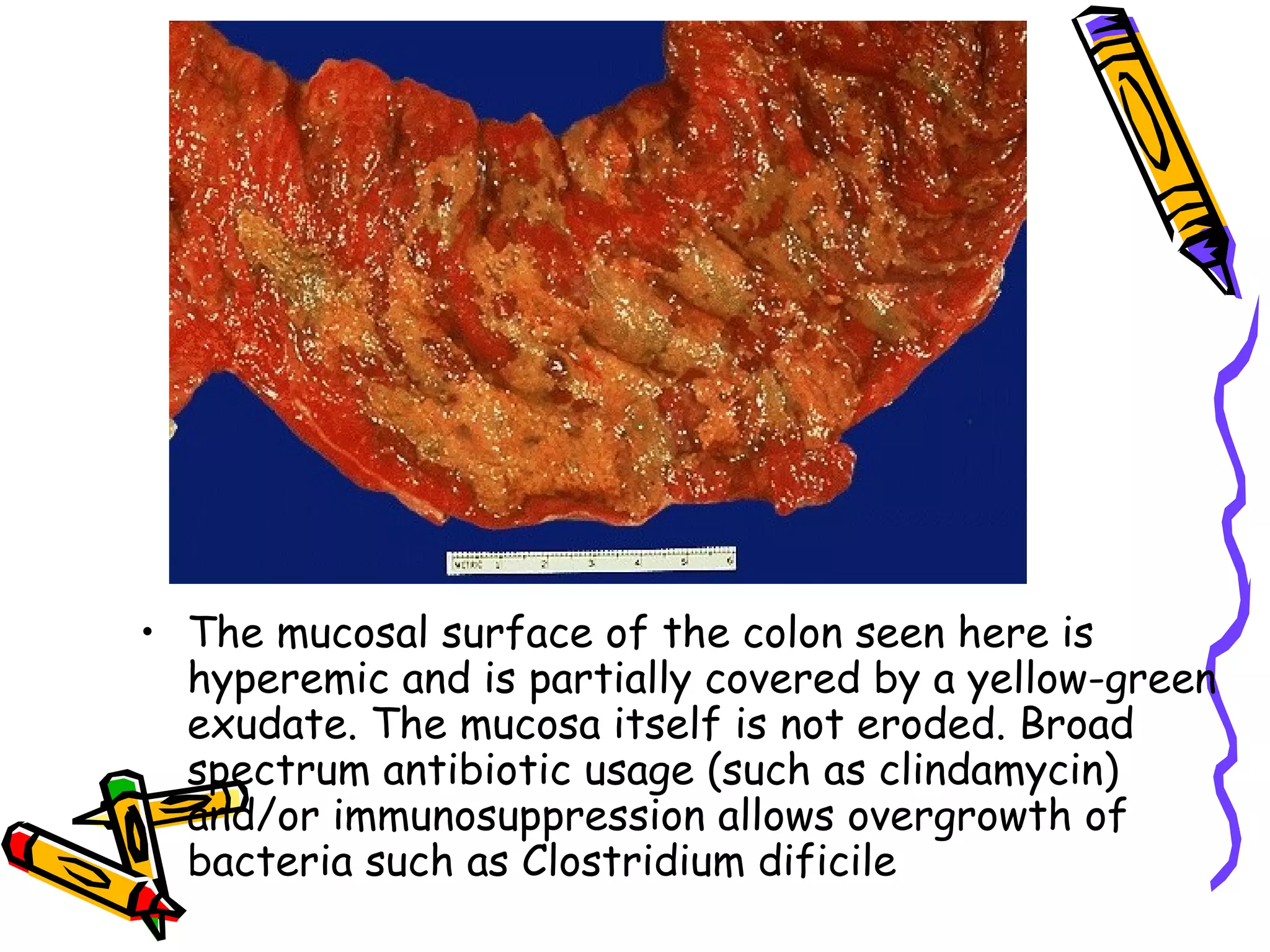 11. Pseudomembranous Colitis Images | PPT