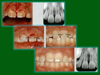 traumatic injuries in children: trauma to teeth and soft | PPTX