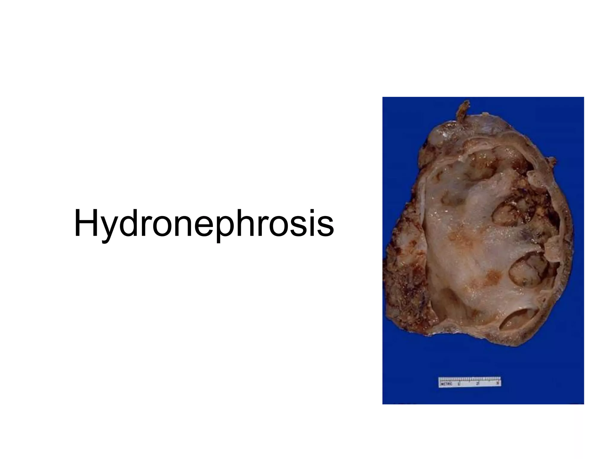 Pathology of The Urinary System | PPT