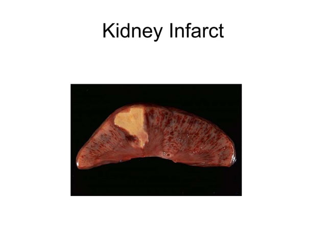 Pathology of The Urinary System | PPT
