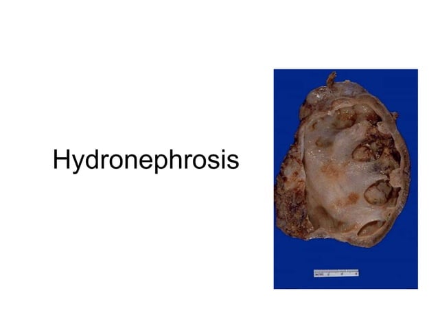 Pathology of The Urinary System | PPT