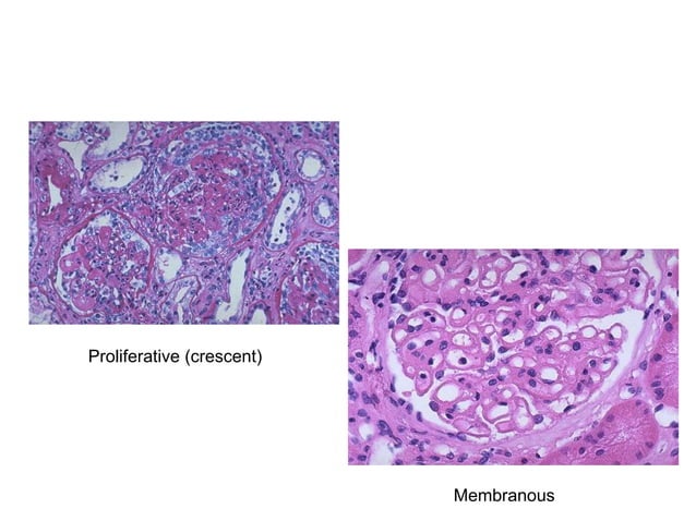 Pathology of The Urinary System | PPT
