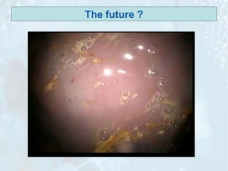 Endoscopy in Gastrointestinal Oncology - Slide 11 - G. Vanbiervliet ...