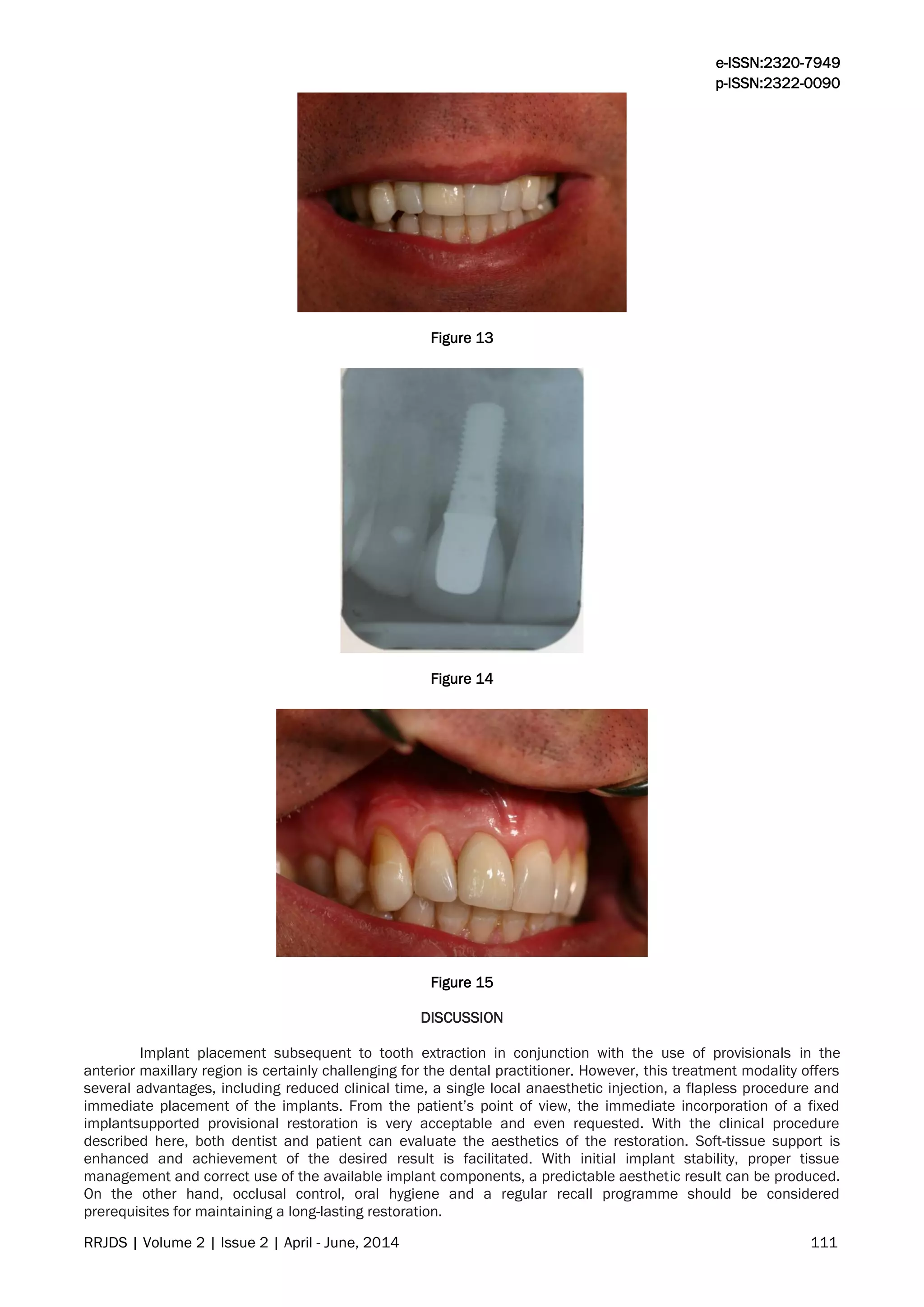 Extraction and Immediate Implant Placement, and Provisionalization with two Years Follow-up: A ...