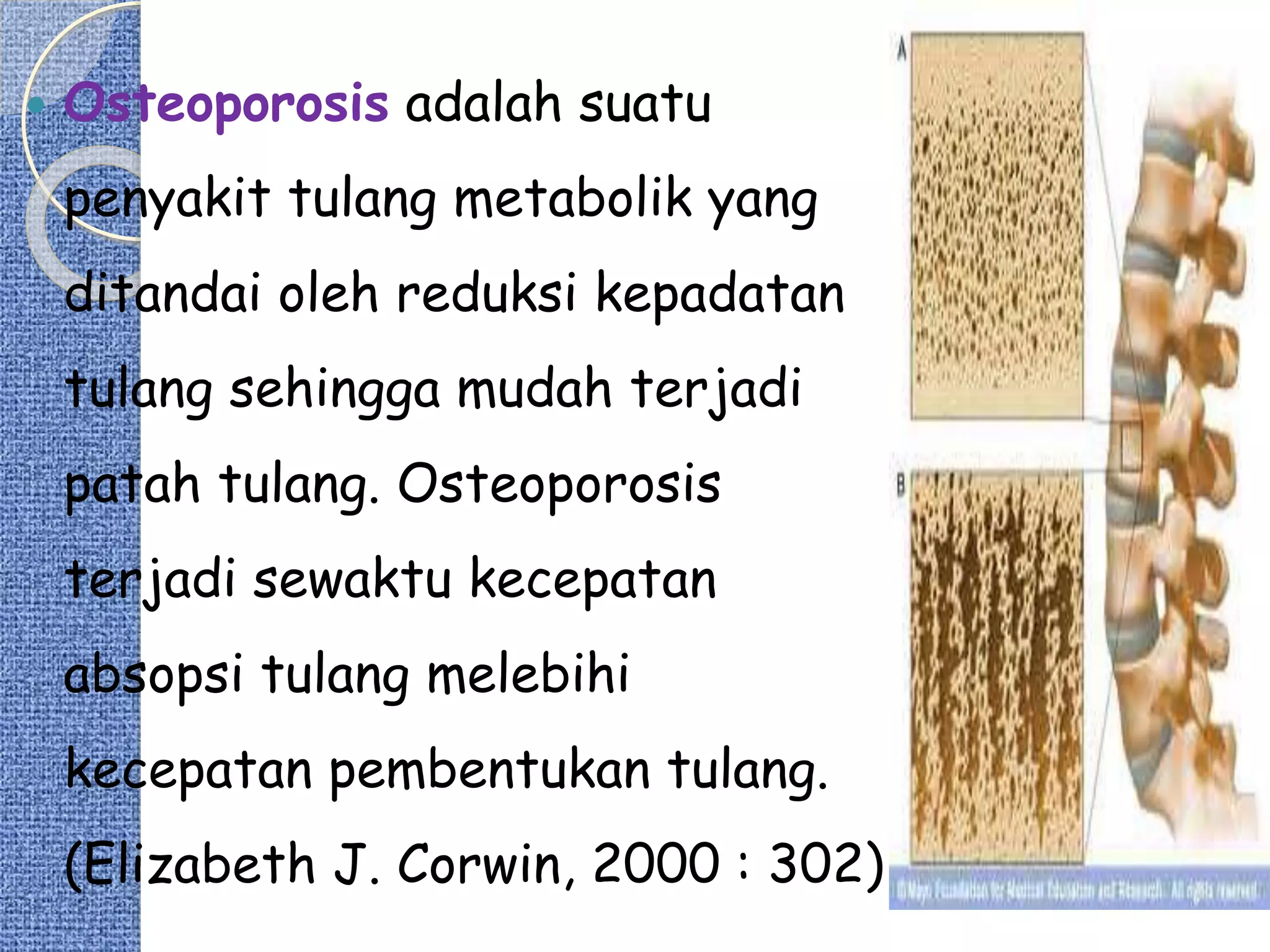 110665563-Osteoporosis-Ppt.pptx