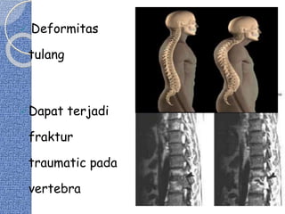 110665563-Osteoporosis-Ppt.pptx