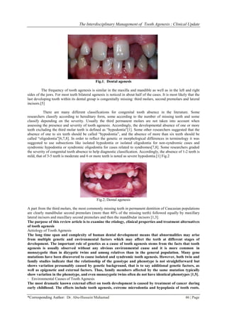 The Interdisciplinary Management of Tooth Agenesis; Clinical Update | PDF