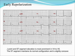 acute pericarditis | PPT