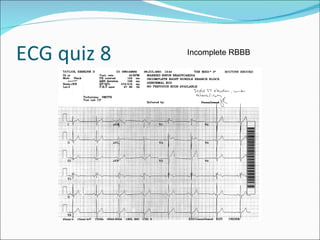 acute pericarditis | PPT