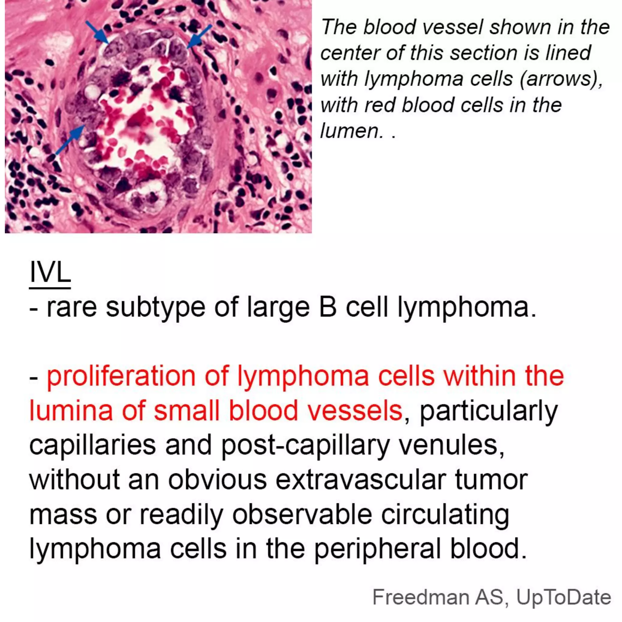 Intravascular large B-cell lymphoma (IVL) | PDF