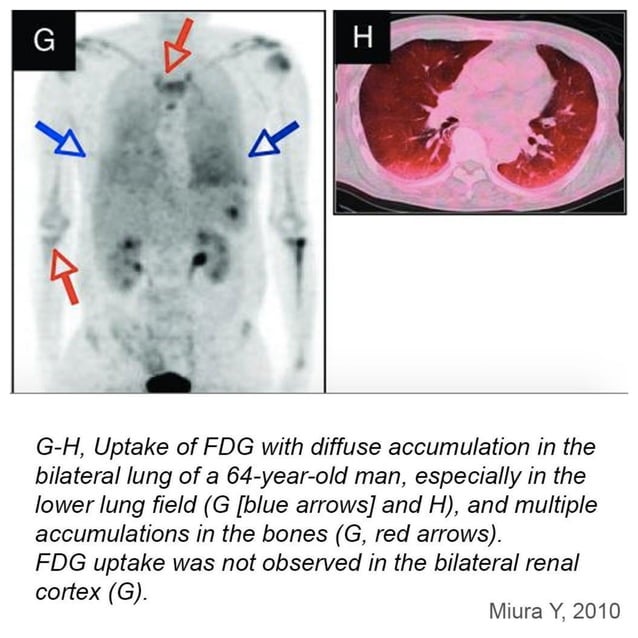 Intravascular large B-cell lymphoma (IVL) | PDF | Blood Disorders | Diseases and Conditions