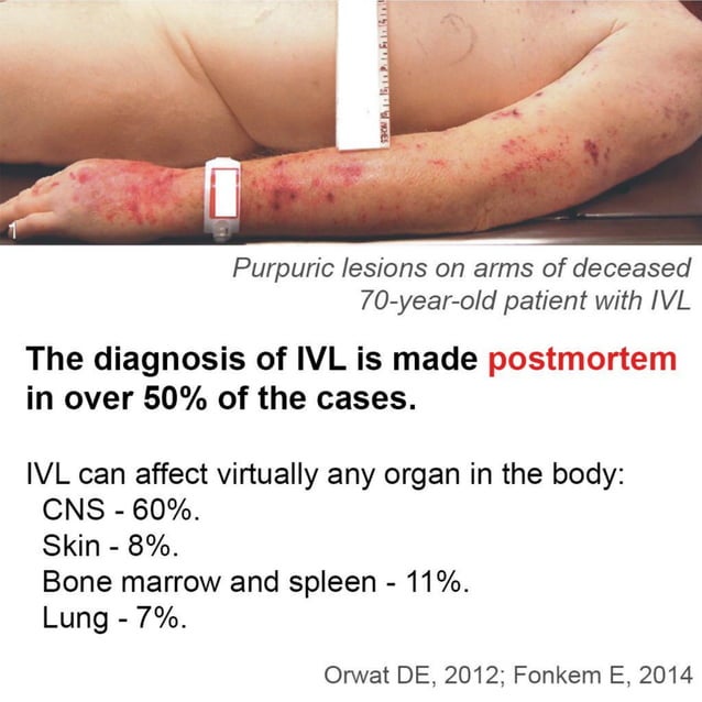 Intravascular large B-cell lymphoma (IVL) | PDF | Blood Disorders | Diseases and Conditions