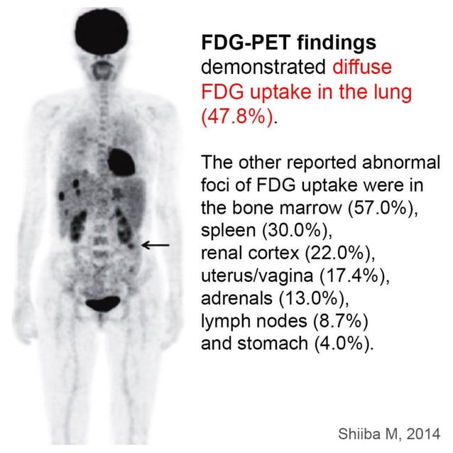 Intravascular large B-cell lymphoma (IVL) | PDF | Blood Disorders | Diseases and Conditions