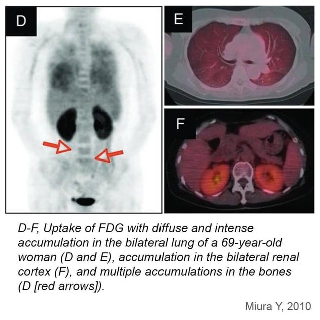 Intravascular large B-cell lymphoma (IVL) | PDF | Blood Disorders | Diseases and Conditions