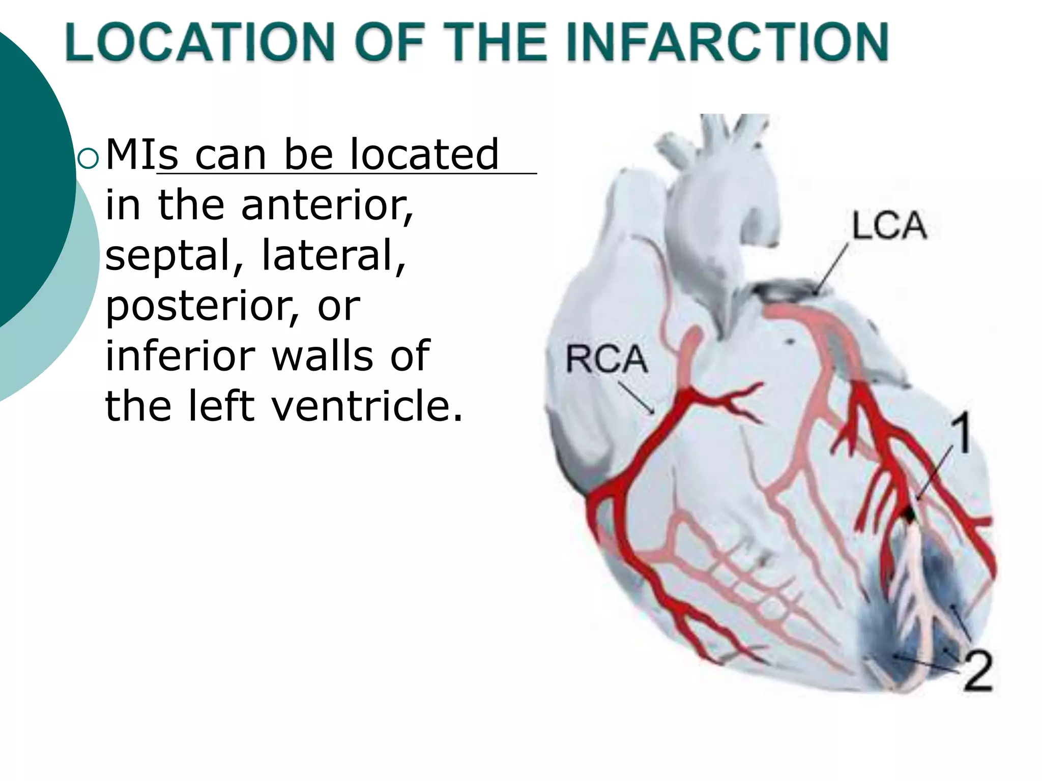 11111801_Myocardial_infarction.ppt
