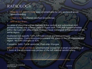 Leptomeningeal Enhancement | PPTX