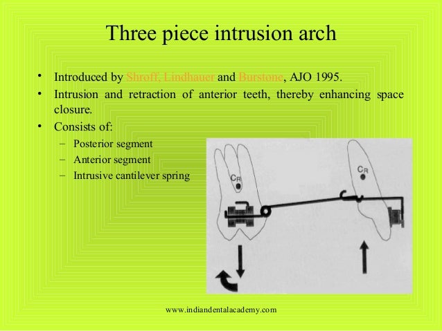 3 piece intrusion arch /certified fixed orthodontic courses /certi…