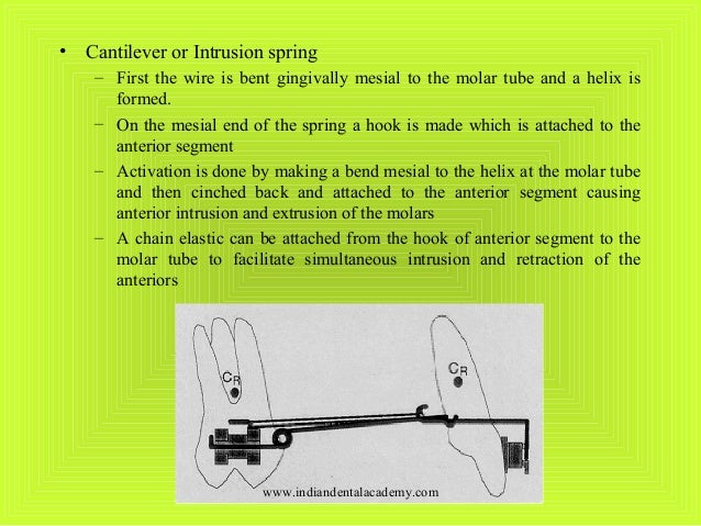 3 piece intrusion arch /certified fixed orthodontic courses /certi…