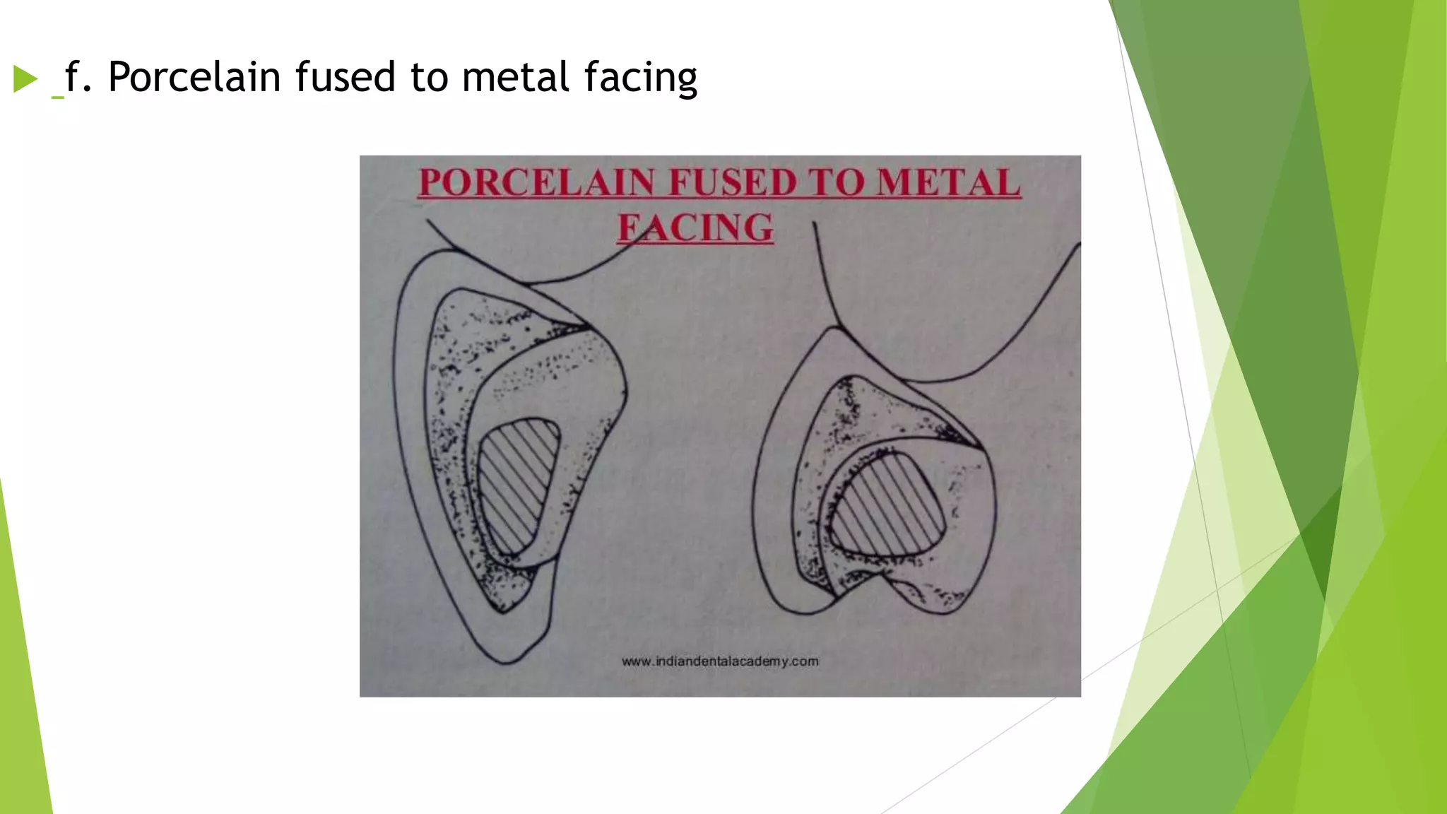 pontics in the prosthetic dentistry | PPTX