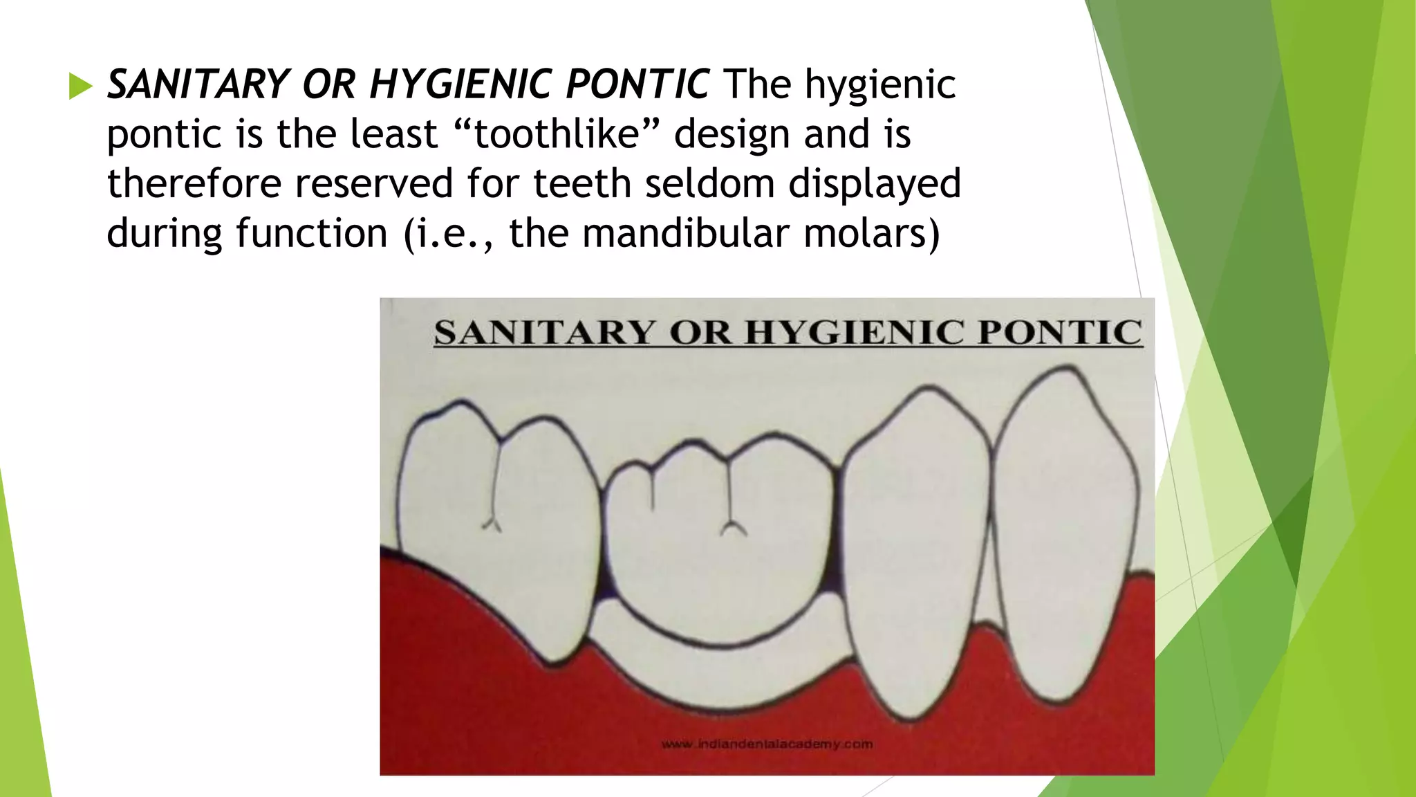 pontics in the prosthetic dentistry | PPTX
