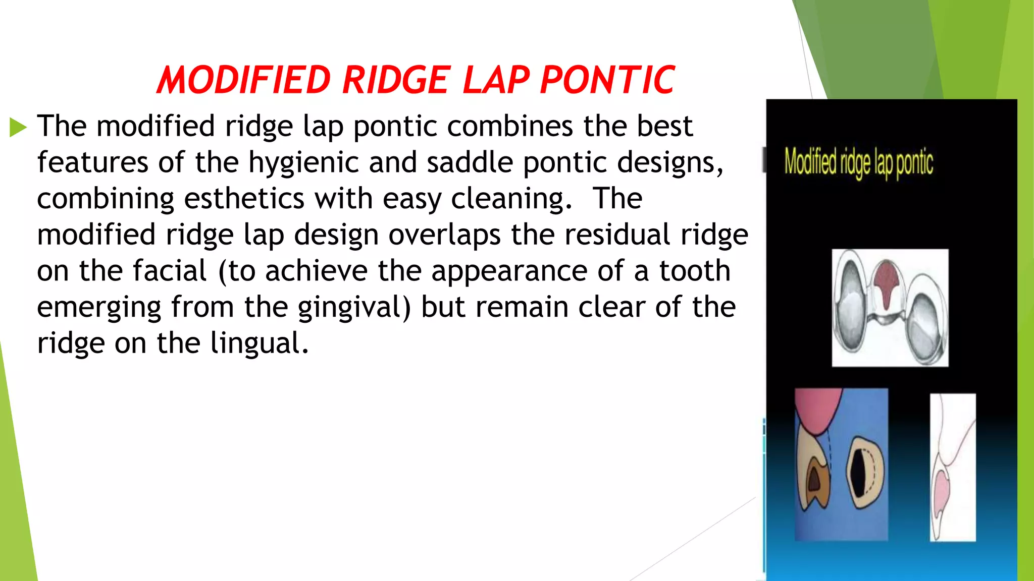 pontics in the prosthetic dentistry | PPTX