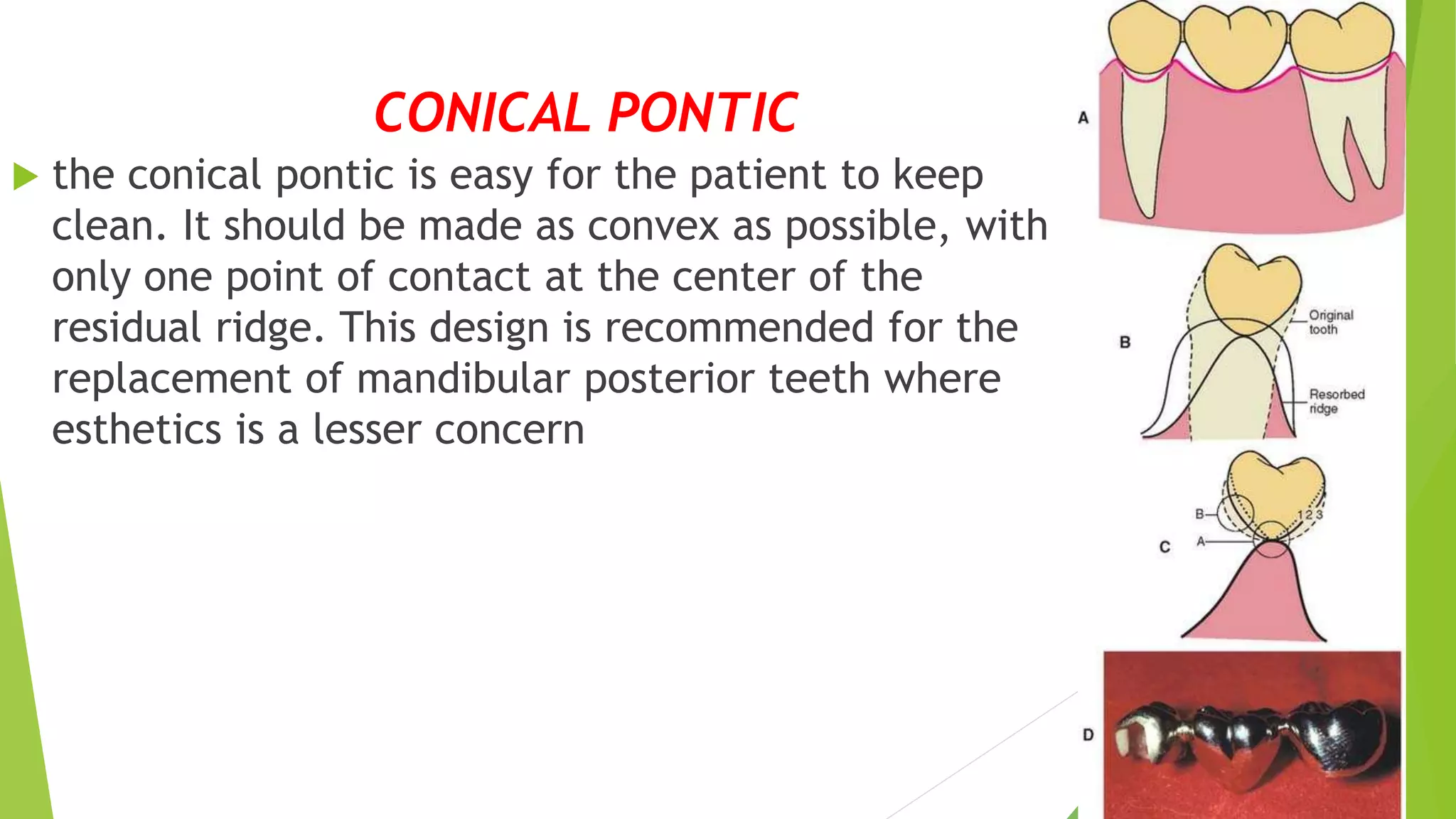 pontics in the prosthetic dentistry | PPTX