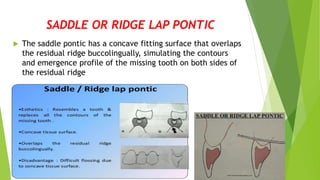 pontics in the prosthetic dentistry | PPTX