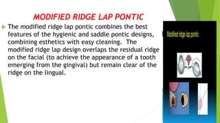 pontics in the prosthetic dentistry | PPTX