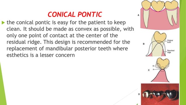 pontics in the prosthetic dentistry | PPTX