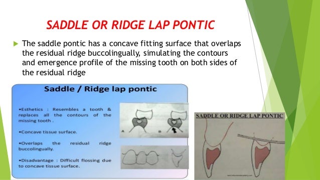 pontics in the prosthetic dentistry