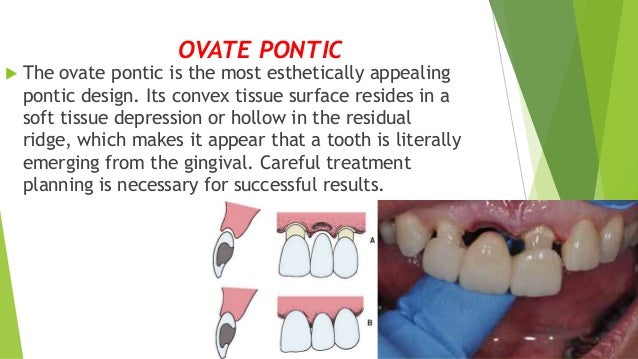 pontics in the prosthetic dentistry