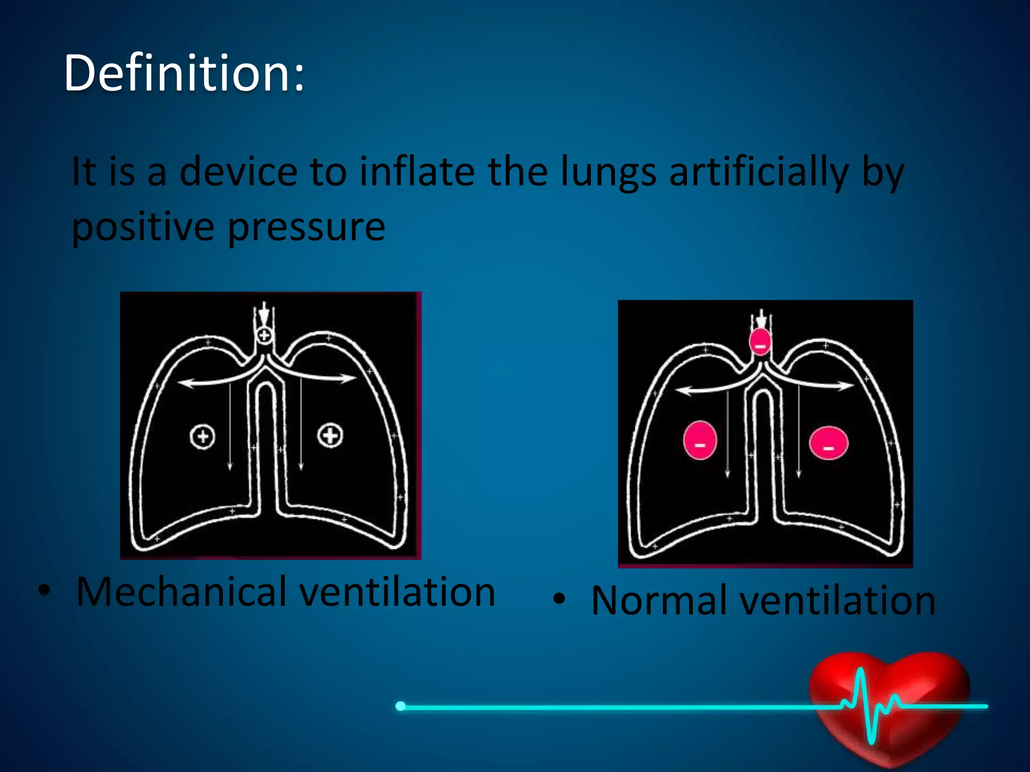 Mechanical ventilation in congenital heart defect | PPTX