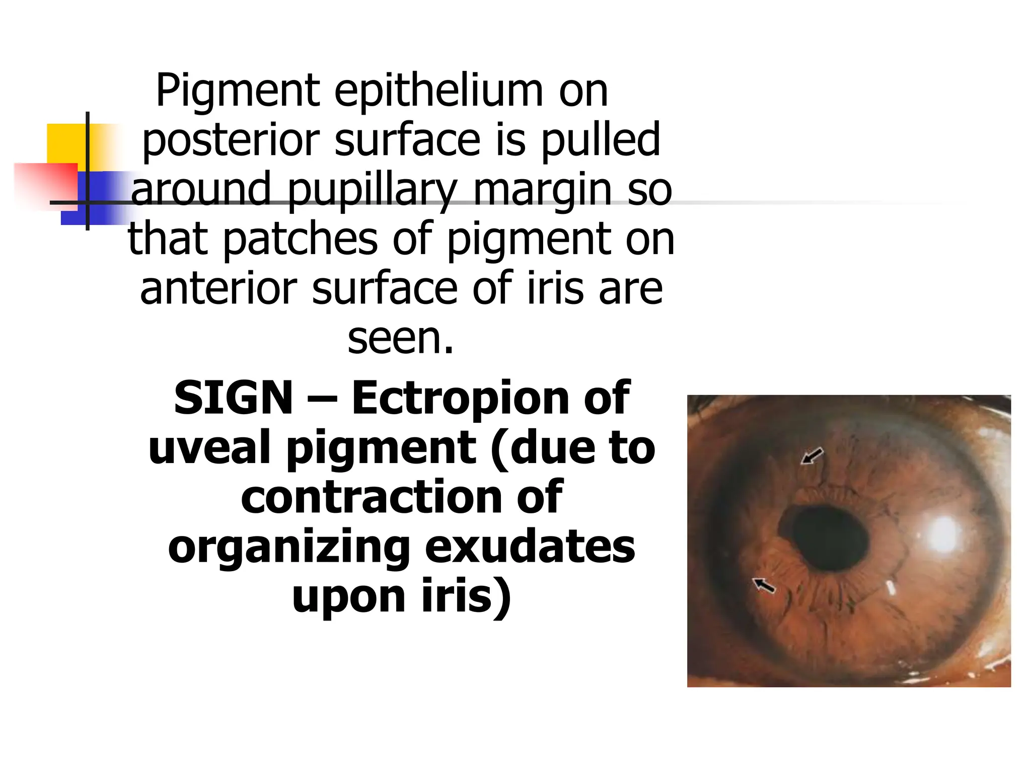 1167_Anterior-Uveitis.ppt (inflammation of iris, cilliary body, choroid ...