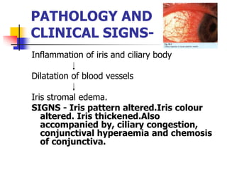 1167_Anterior-Uveitis.ppt (inflammation of iris, cilliary body, choroid ...