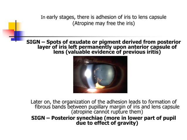 1167_Anterior-Uveitis.ppt (inflammation of iris, cilliary body, choroid ...