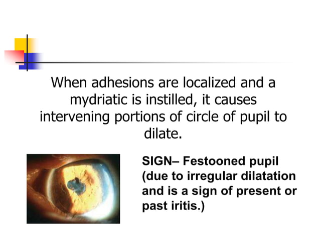 1167_Anterior-Uveitis.ppt (inflammation of iris, cilliary body, choroid ...