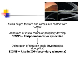 1167_Anterior-Uveitis.ppt (inflammation of iris, cilliary body, choroid ...