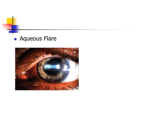 1167_Anterior-Uveitis.ppt (inflammation of iris, cilliary body, choroid ...
