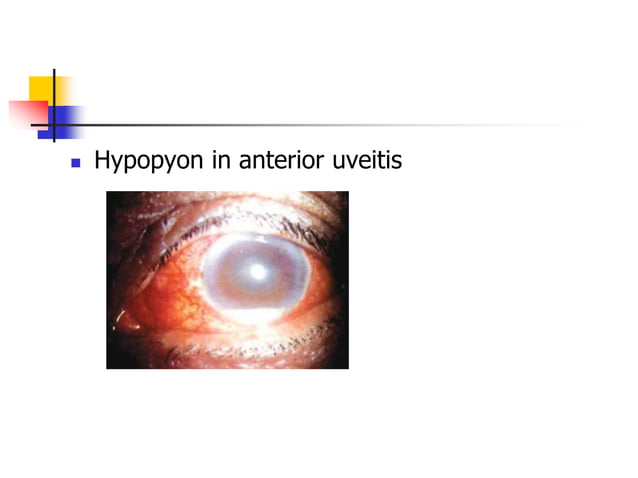 1167_Anterior-Uveitis.ppt (inflammation of iris, cilliary body, choroid ...