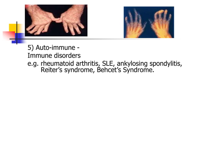 1167_Anterior-Uveitis.ppt (inflammation of iris, cilliary body, choroid ...