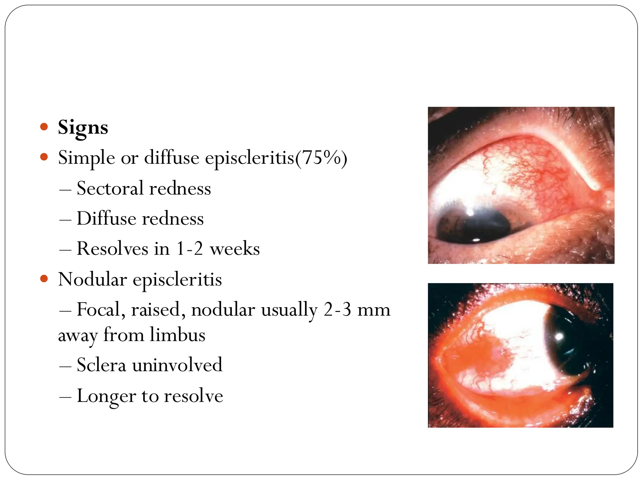1168_Episcleritis-and-Scleritis.pdf fir jrs | PDF