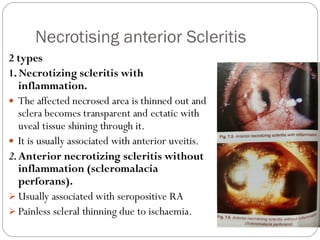 1168_Episcleritis-and-Scleritis.pdf fir jrs | PPT