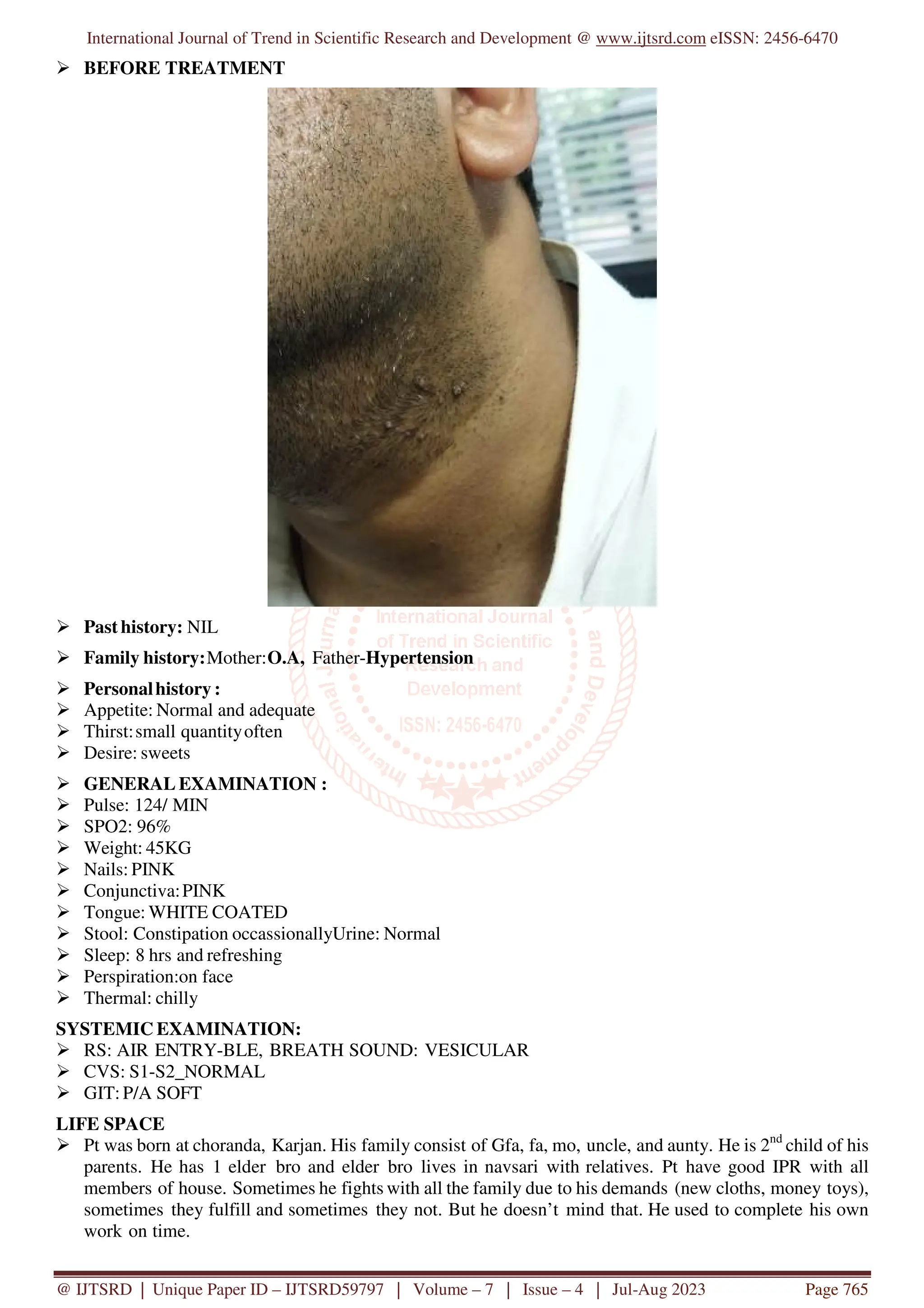 Case of Warts Treated by Constitutional Case Study Approach | PDF