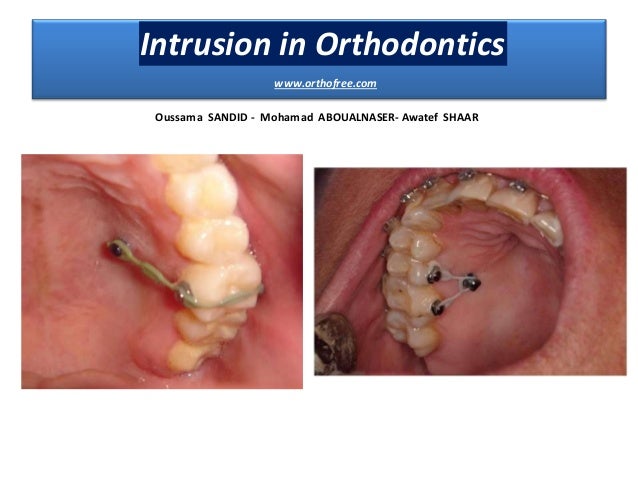 117 intrusion in orthodontics-oussama sandid-mohamad aboualnaser-moha…