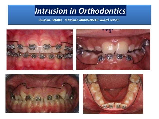 117 intrusion in orthodontics-oussama sandid-mohamad aboualnaser-moha…